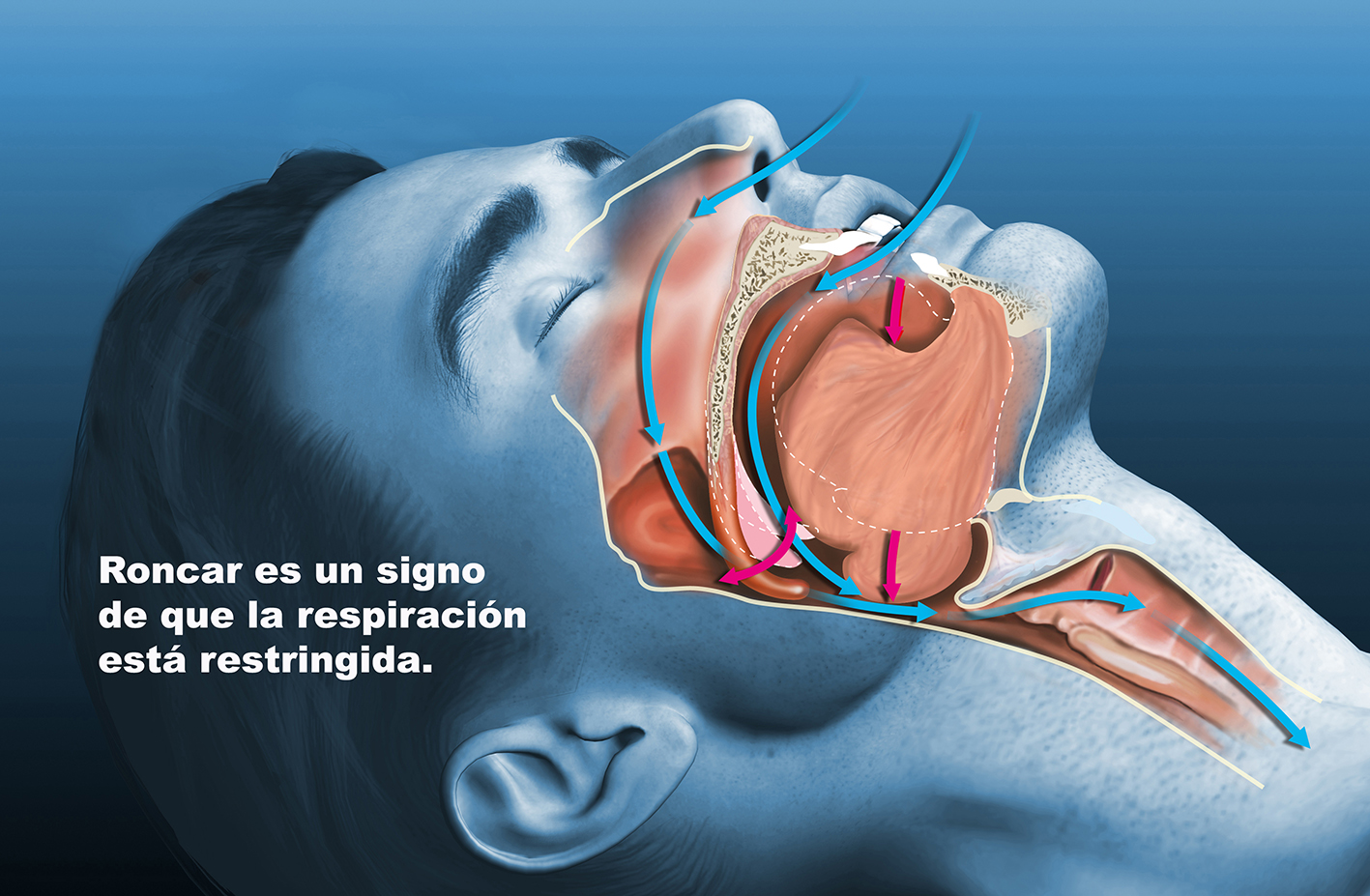 Salga de dudas con los ronquidos - Mi Bienestar - Expertos en salud